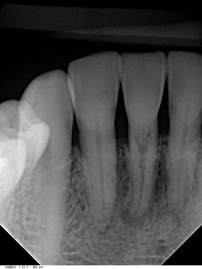 Resorption - Saddleback Valley Endodontics