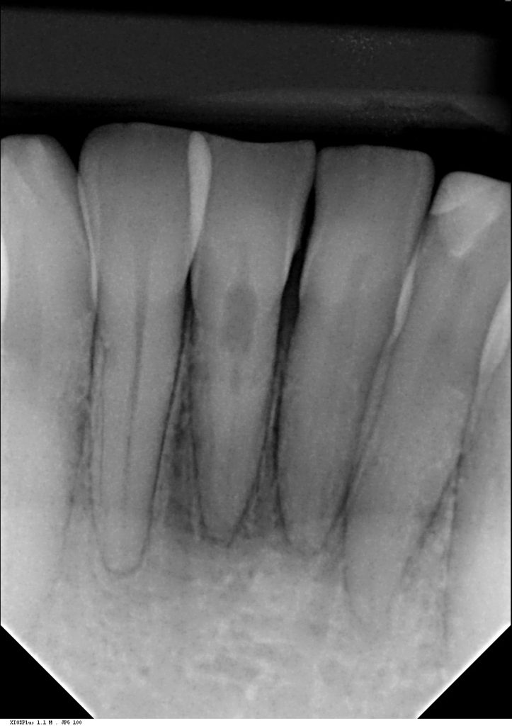 Root Canal Safety - Saddleback Valley Endodontics